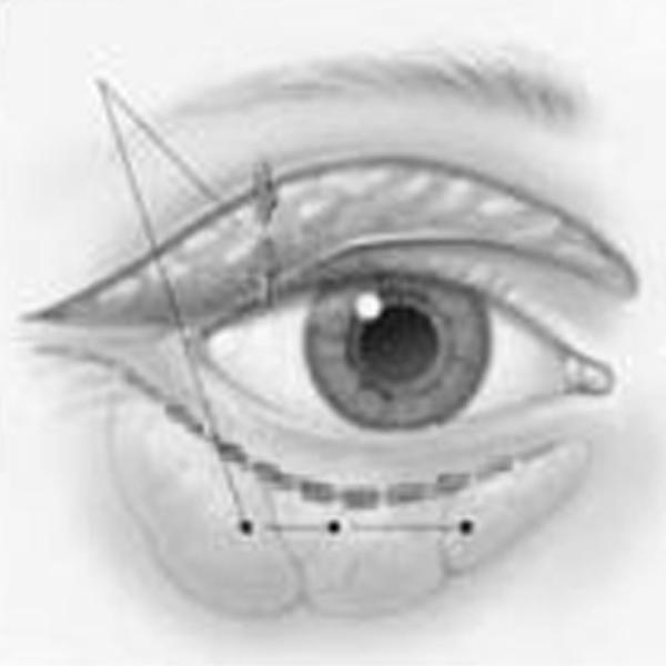 Pálpebras - Dr. Bruno C. André